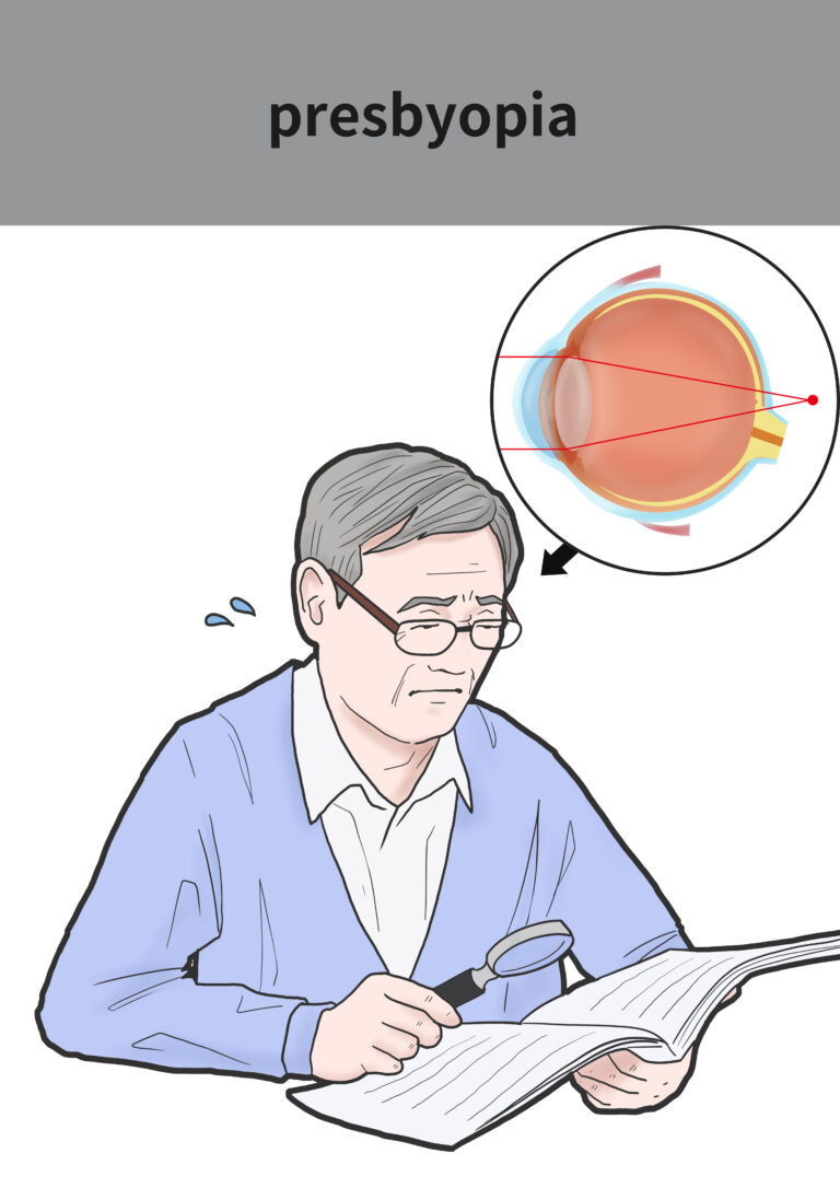 Presbyopia | Can't | See | Focus | Read | Close Up | All of a Sudden