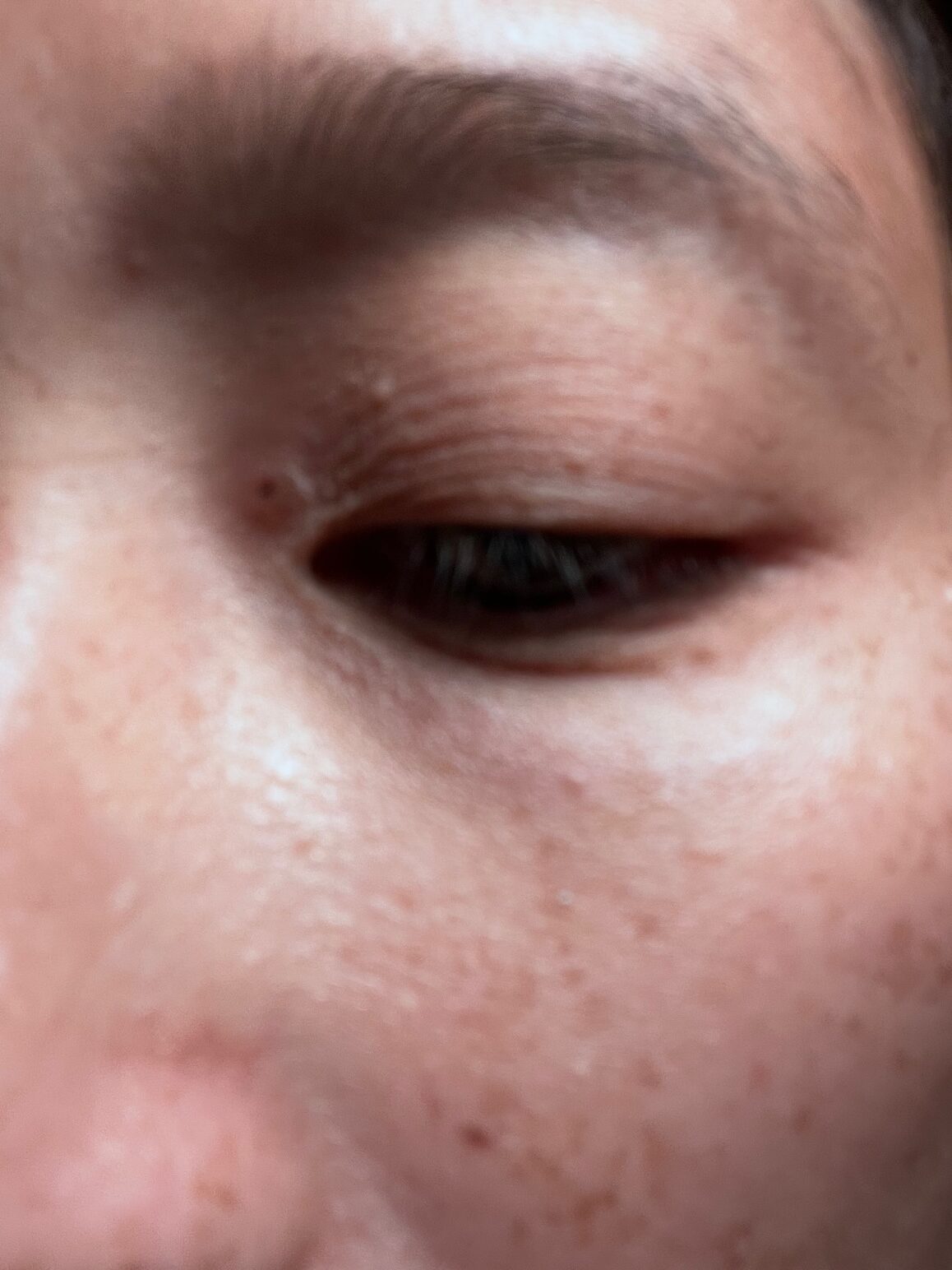 Lumenis | Optilight | IPL | Dry Eye Treatment | How to cure dryness